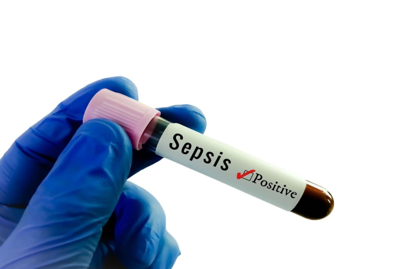 Simptom Sepsis: Ini Penjelasan Apa Itu Sepsis dan Tanda-Tandanya!