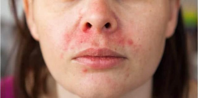Dermatitis Atopik Adalah Sama Seperti Penyakit Kulit Ekzema, Betul Ke?