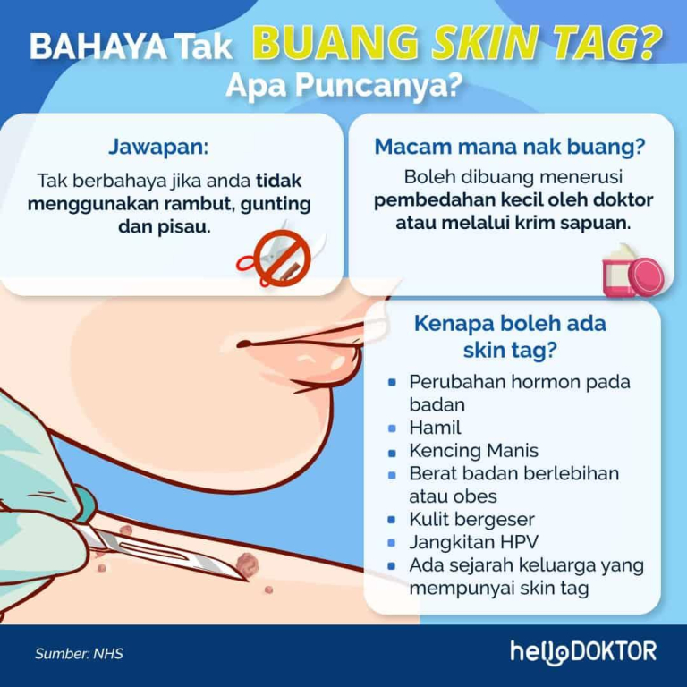 Punca Kutil Tumbuh Di Badan: Ketahui Simptm & Cara Mengatasinya!