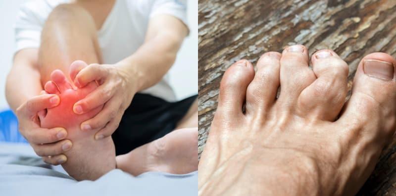 Sakit Gout Dan Arthritis, Apa Yang Anda Perlu Tahu Antara Keduanya?