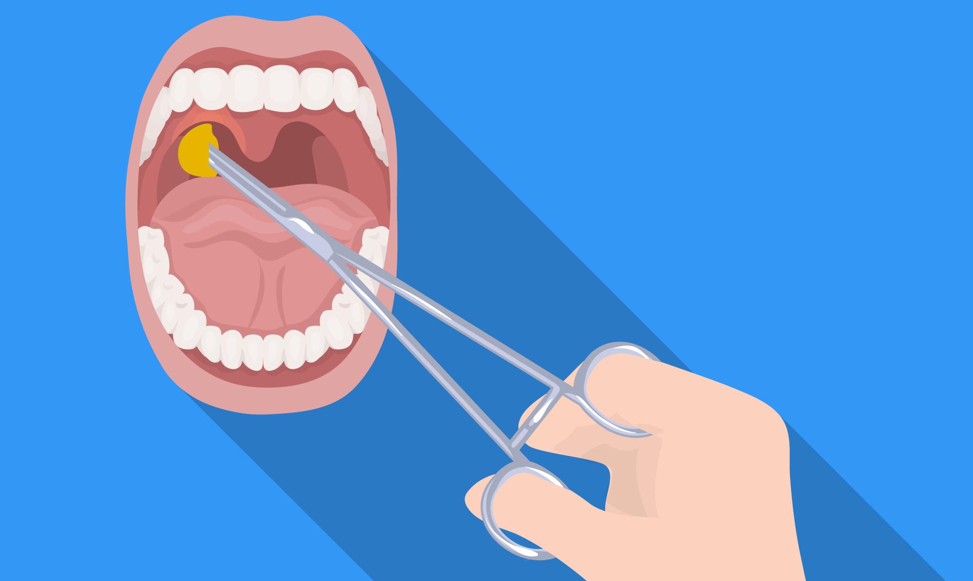 Tonsilektomi: Keperluan Pembedahan Membuang Tonsil - Hello Doktor