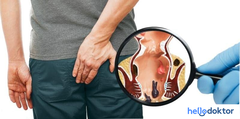 Cara Rawat Buasir: Lakukan Ini Untuk Kurangkan Kesakitan!