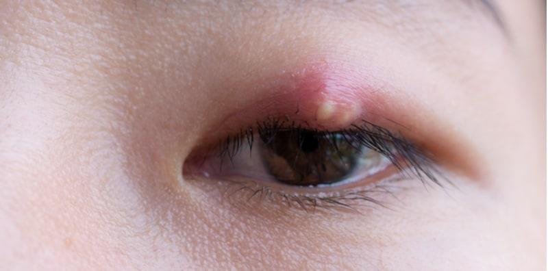 Mata Ketumbit Bahaya Ke? Ini Cara Untuk Merawatnya Di Rumah!