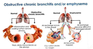 COPD: Perbezaan Bronkitis Kronik Dan Emfisema - Hello Doktor