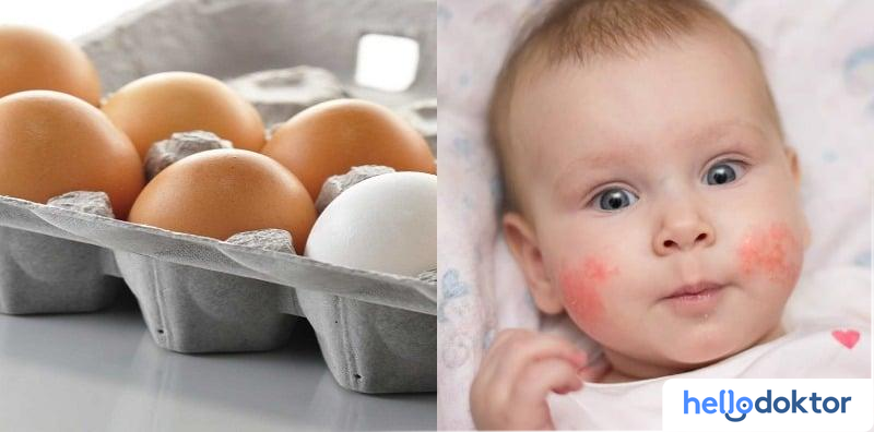 Anak Alergi Telur? Ibu Bapa Kena Kenal Pasti Petanda Pada Kanak-kanak!