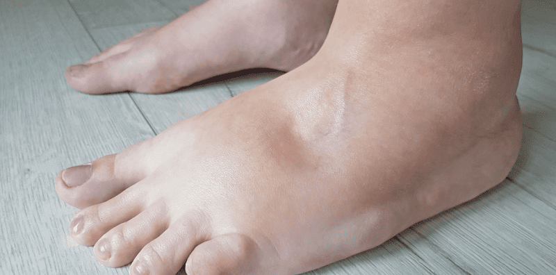 Punca Kaki Bengkak: Fahami Faktor Yang Mendasarinya - Hello Doktor