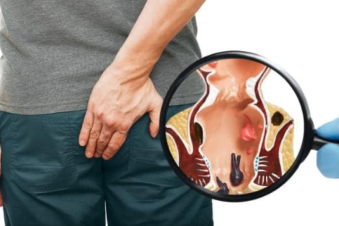 Cara Rawat Buasir: Lakukan Ini Untuk Kurangkan Kesakitan!