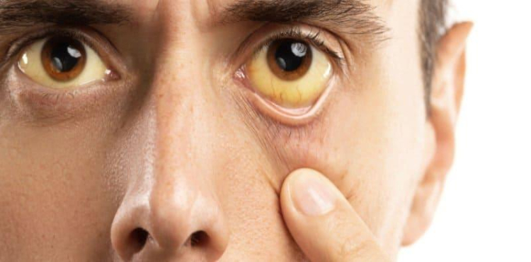 Masalah Berkaitan Mata: Awas Jika Anda Alami 8 Simptom Mata Ini!