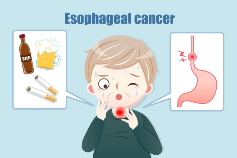 Kanser Esofagus Boleh Sebabkan Kematian - Hello Doktor