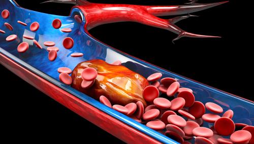 Embolisme Pulmonari: Penyumbatan Saluran Darah di Paru-paru - Hello Doktor