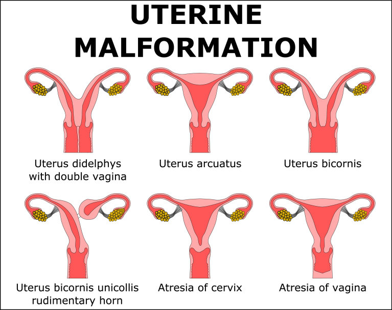 Risiko Jika Wanita Ada Dua Rahim - Hello Doktor