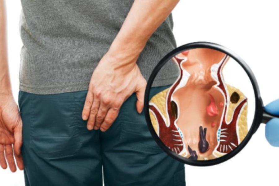 Ciri ciri Buasir & 4 Puncanya Yang Anda Patut Tahu, Elak Lebih Parah