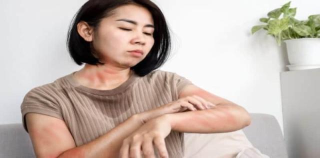 Cara Hilangkan Ruam Panas Bayi & Dewasa Serta Cara Mencegahnya