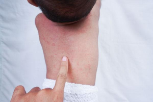 Cara Hilangkan Ruam Panas Bayi & Dewasa Serta Cara Mencegahnya