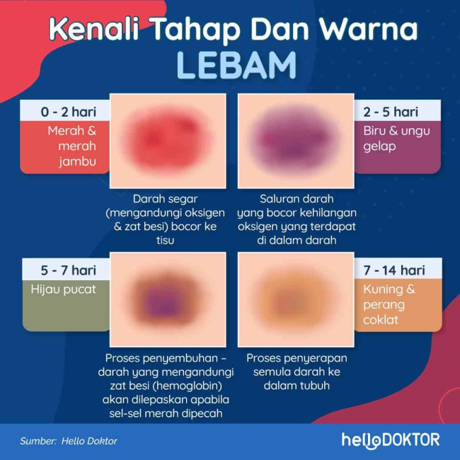 Punca Lebam, Fahami Faktor Risiko & Cara Mengatasinya