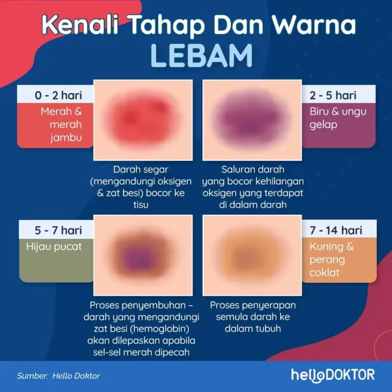 Punca Lebam, Fahami Faktor Risiko & Cara Mengatasinya