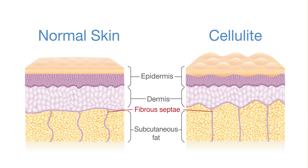 11 Tip Menghilangkan Selulit Untuk Dicuba - Sure Berkesan! - Hello Doktor