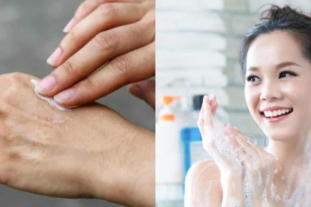 Cara Menghilangkan Panau Dalam Sehari, Ini Senarai Petua Boleh Cuba!