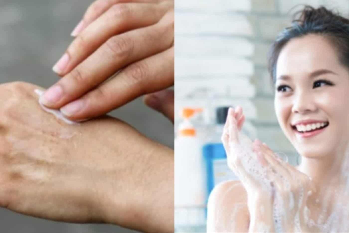 Cara Menghilangkan Panau Dalam Sehari, Ini Senarai Petua Boleh Cuba!