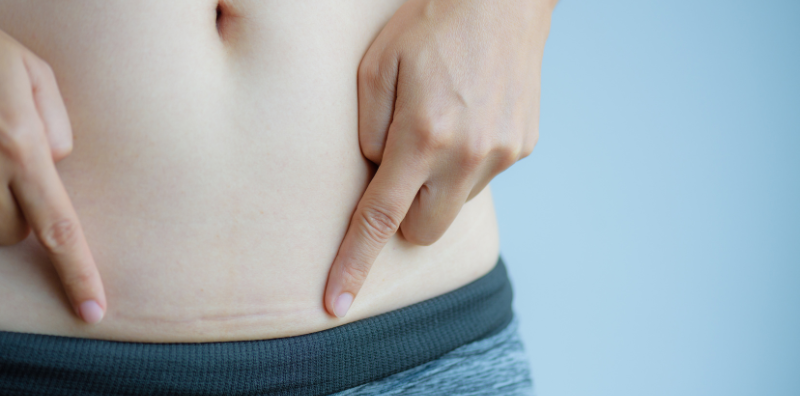 Luka Pembedahan Czer? Ini Tip Berkesan Untuk Ibu Merawatnya!