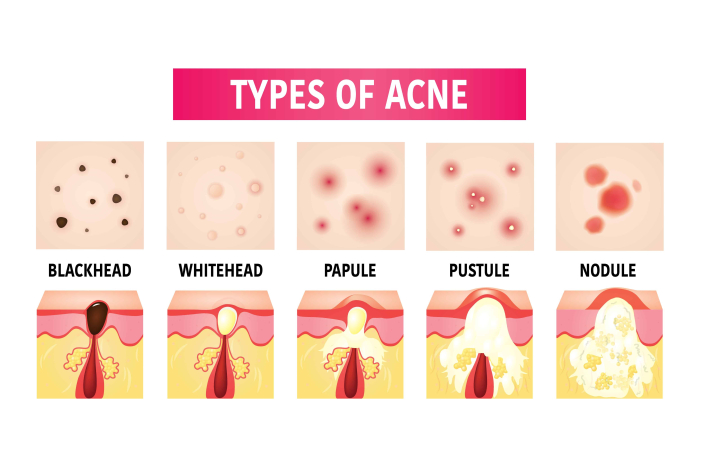 Jenis Jerawat Yang Tumbuh Di Wajah, Senang Nak Rawat Nanti