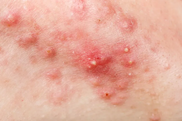 Jenis Jerawat Yang Tumbuh Di Wajah, Senang Nak Rawat Nanti