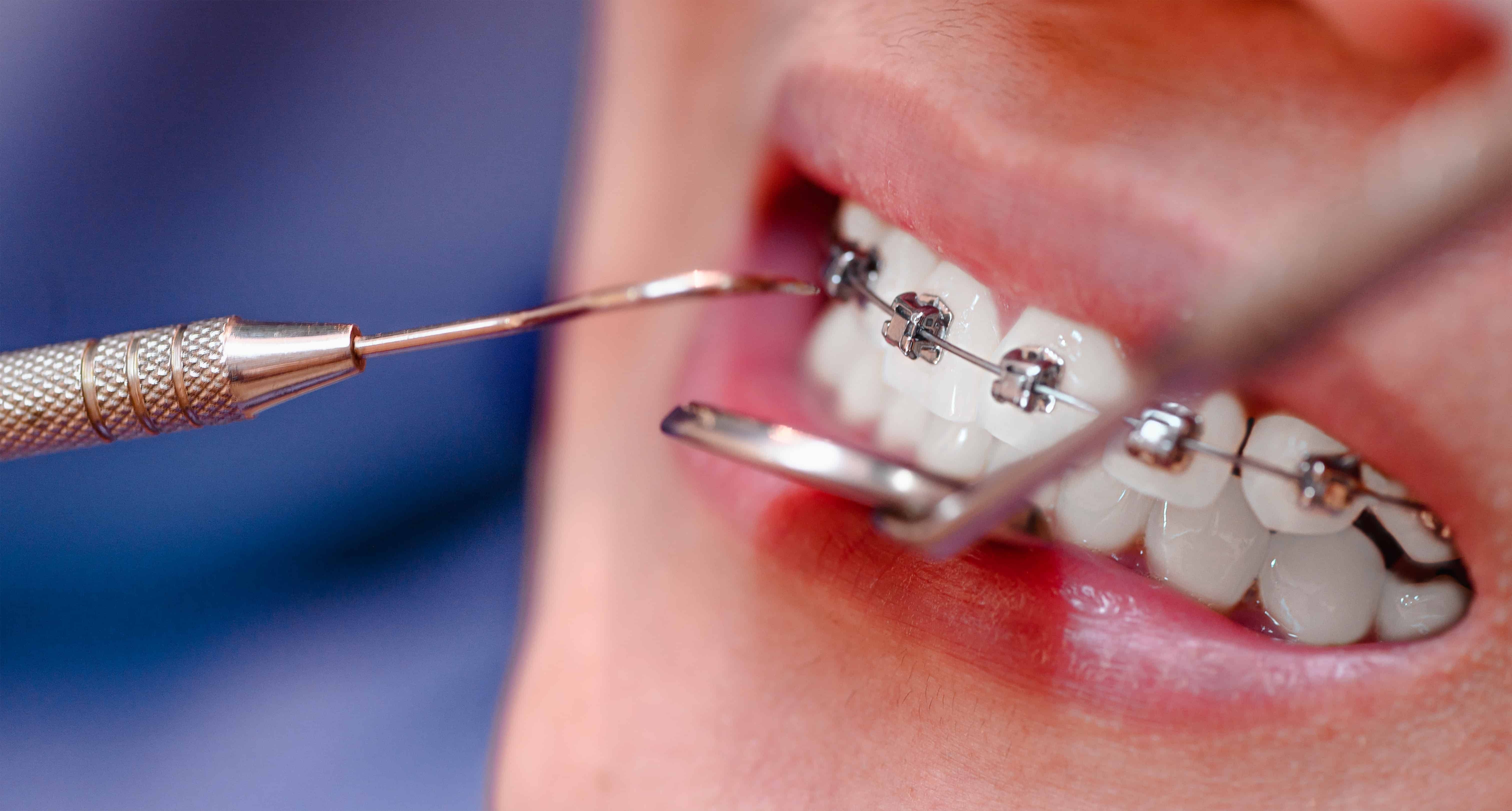 Tempoh Pemakaian Braces? Ini Yang Patut Anda Tahu...