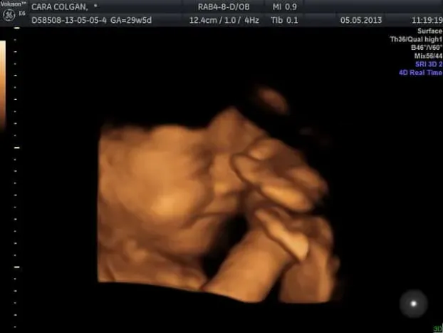 Scan Bayi 2D, 3D, 4D: Yang Mana Lebih Baik Untuk Ibu Hamil?