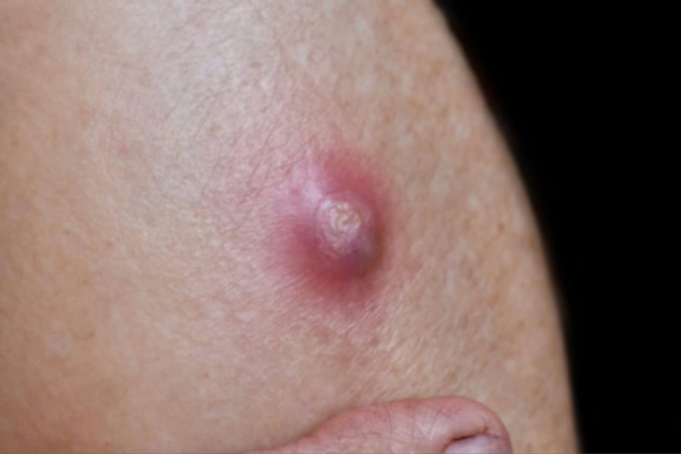 Cara Menghilangkan Bisul Di Badan, Ini Tip Elak Tinggalkan Parut!