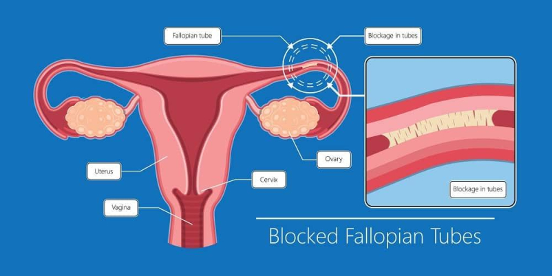 Tiub Fallopio Tersumbat Boleh Dirawat Secara Semula Jadi? - Hello Doktor