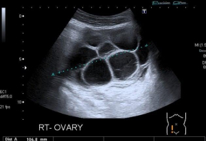 Ovari Bengkak Simptom OHSS, Gara-gara Ambil Banyak Pil Subur