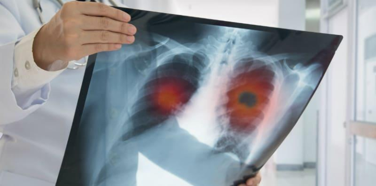 Paru Paru Berair (Pulmonary Edema): Ini Punca, Risiko & Rawatannya