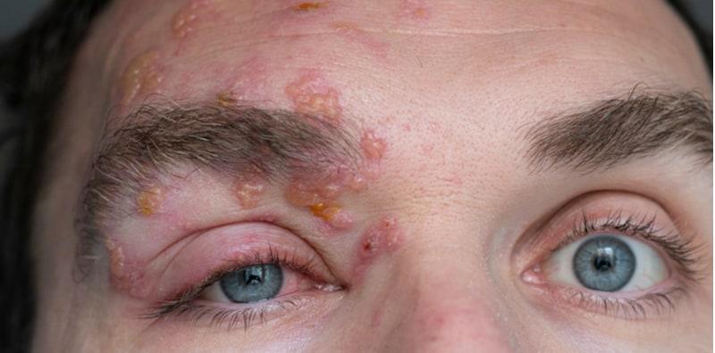 Apa Itu Kayap? Ini Penerangan Ringkas Berkenaan Dengan Penyakit Ini