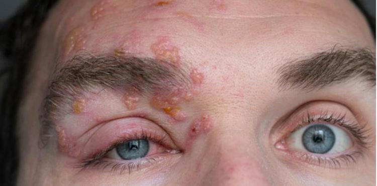 Apa Itu Kayap? Ini Penerangan Ringkas Berkenaan Dengan Penyakit Ini