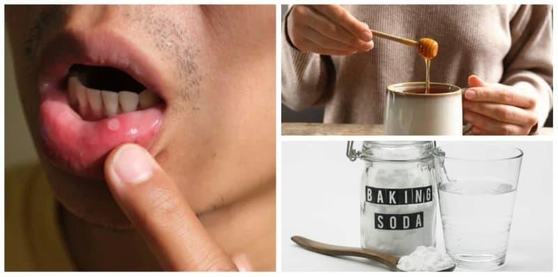 Mata Ikan Tumbuh Di Mulut? Cuba 6 Cara Natural Ini Untuk Merawatnya