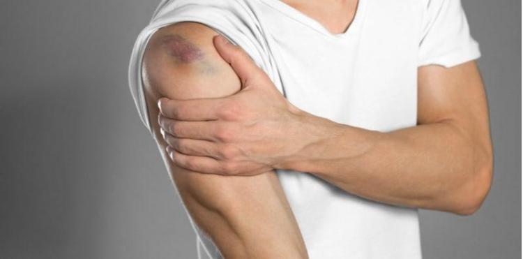 Kesan Lebam Berubah Jadi Kuning? Kenali Warna Lebam & Bahayanya!