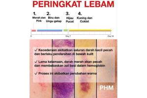 Kesan Lebam Berubah Jadi Kuning? Kenali Warna Lebam & Bahayanya!