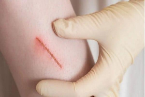 Ubat Kuning Luka: Ada Kesan Sampingan Jika Salah Cara Guna! Iodin