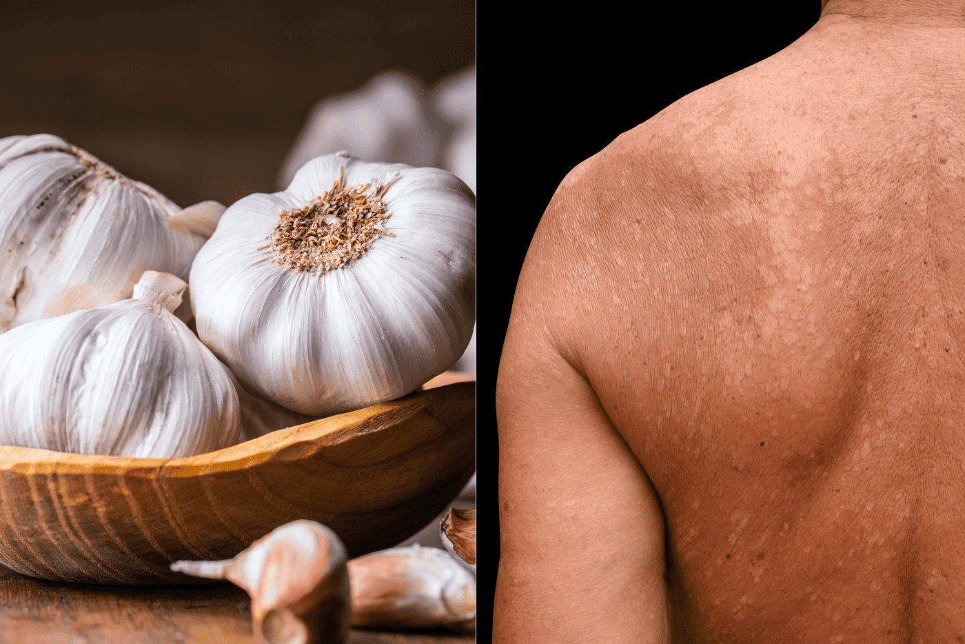 Cara Hilangkan Panau Secara Saintik: Boleh Buat Sendiri Di Rumah!