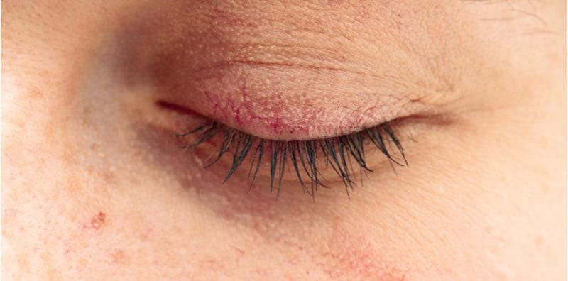 Kelopak Mata Gatal Dan Kering, Kenal Pasti Simptom Dermatitis