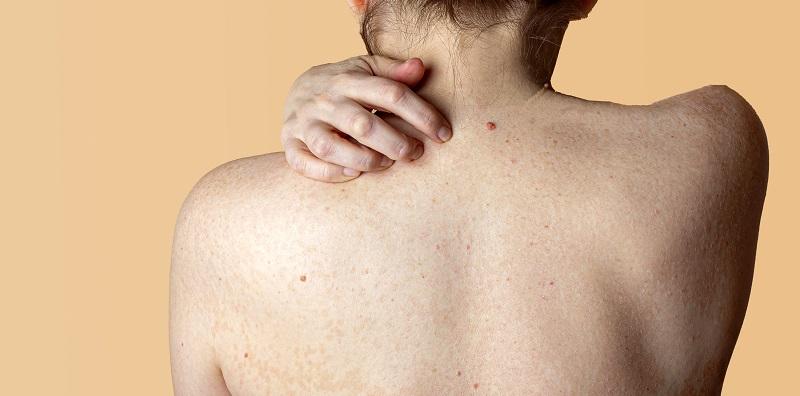 Jangkitan Kulit: Jenis, Simptom, Punca, Diagnosis Dan Rawatan