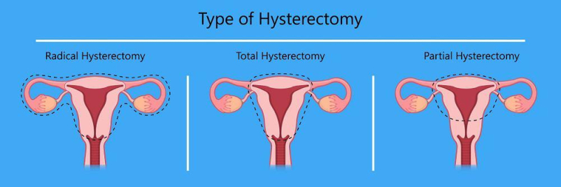 Kesan Selepas Buang Rahim, Wanita Ambil Tahu Pro & Konta Histerektomi