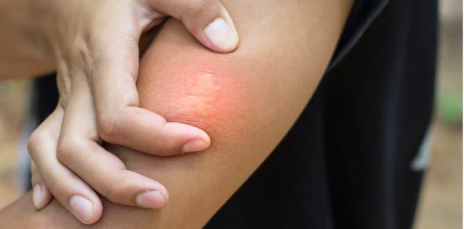 Sengat Lebah: Apa Perlu Buat Jika Kena, Cukupkah Tuaman Ais?