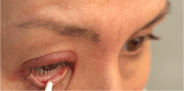 Ketumbit Dalam Mata: Apa Beza Dengan Yang Berlaku Di Luar Kelopak?