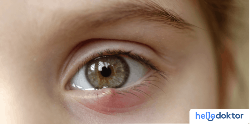 Ketumbit Bawah Mata & Atas Mata Di Kelopak: Mana Lebih Berbahaya?