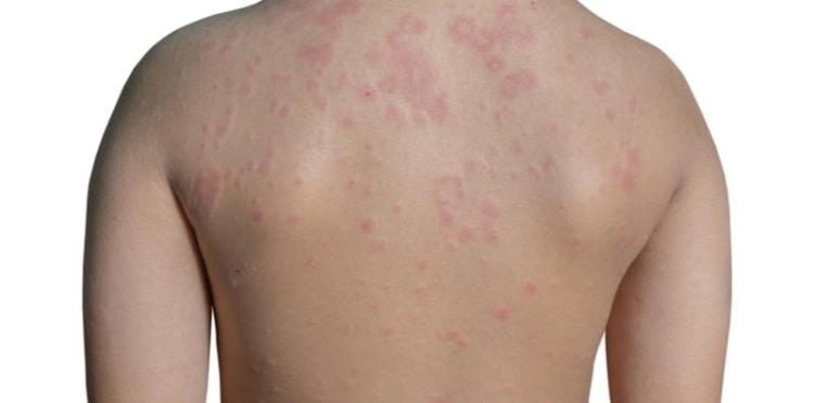 Urtikaria Adalah Kondisi Kulit Yang Berbahaya? Ini Punca Timbul Gegata