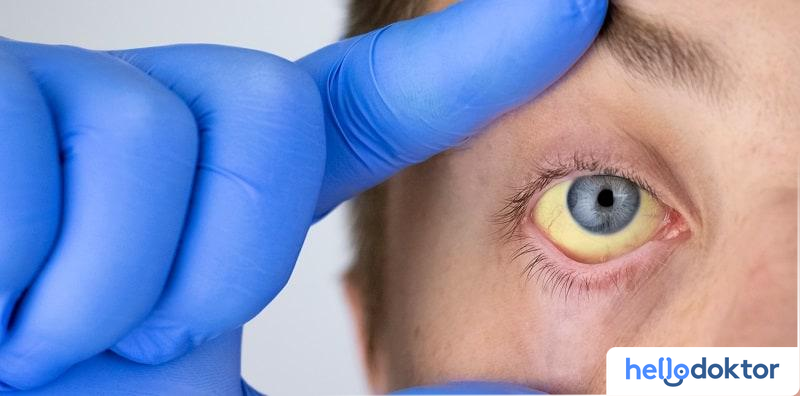 Apa Itu Hepatitis? Ini ABC Hepatitis Yang Anda Perlu Tahu! - Hello Doktor