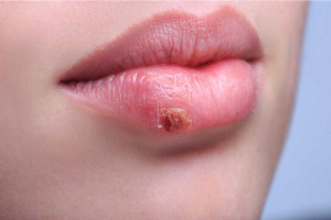 Penyakit Bibir Ekzema: Ini Punca Bibir Kering, Merah & Berkeruping!