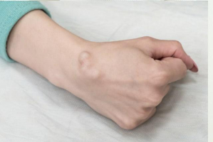 Jenis Cyst Ada Banyak! Ini 5 Jenis Yang Boleh Dikenal Pasti