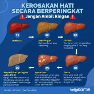 Apa Itu Sirosis Hati: Ini Komplikasi Yang Mungkin Berlaku Jika Dibiarkan!